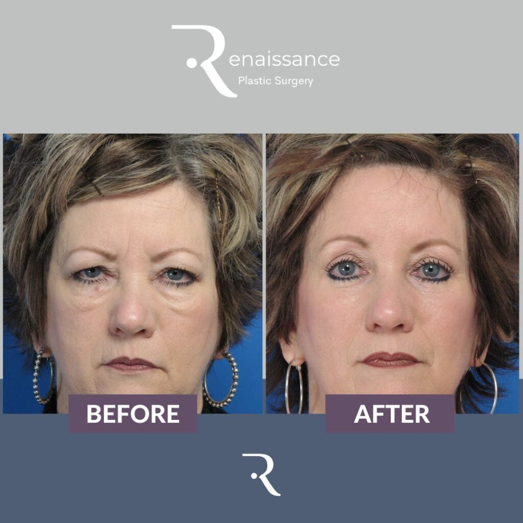 Brow Lift Before and After - Renaissance Plastic Surgery