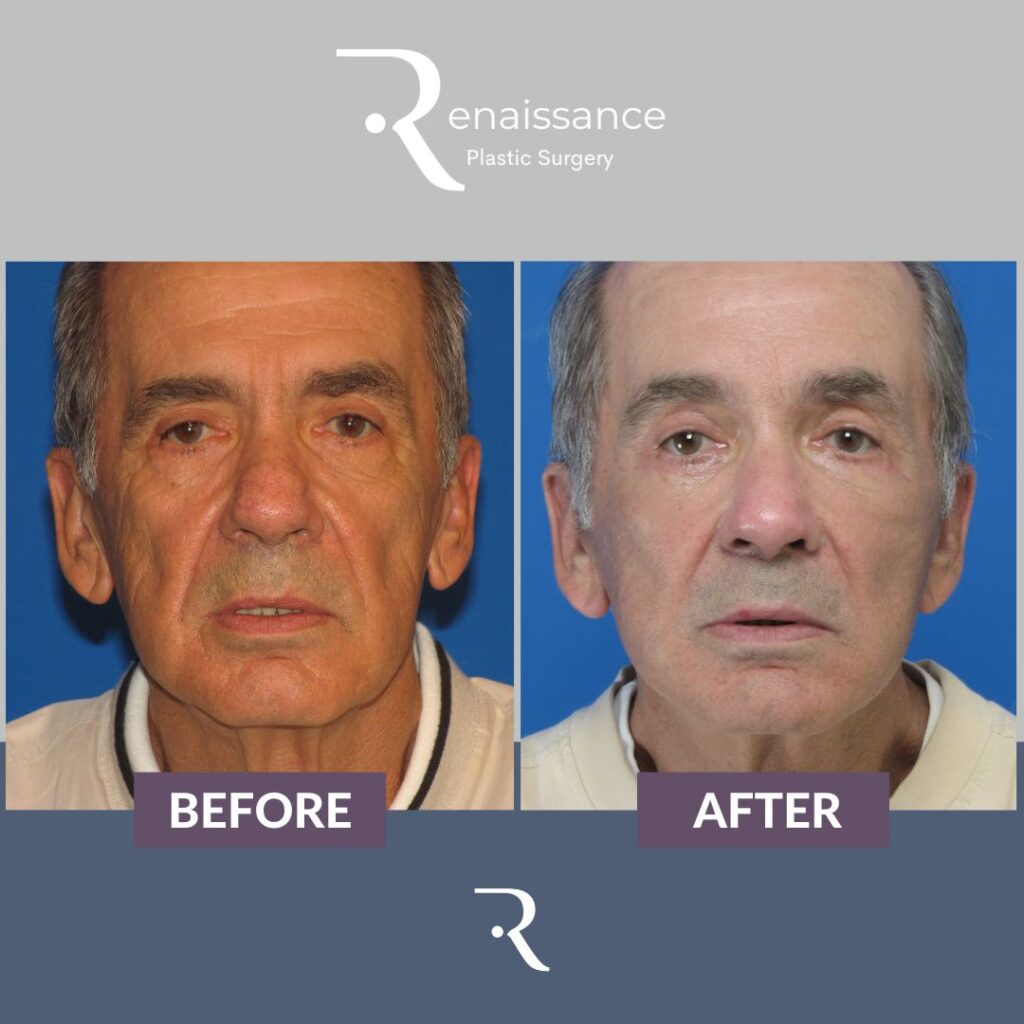 Brow Lift Before and After - Renaissance Plastic Surgery