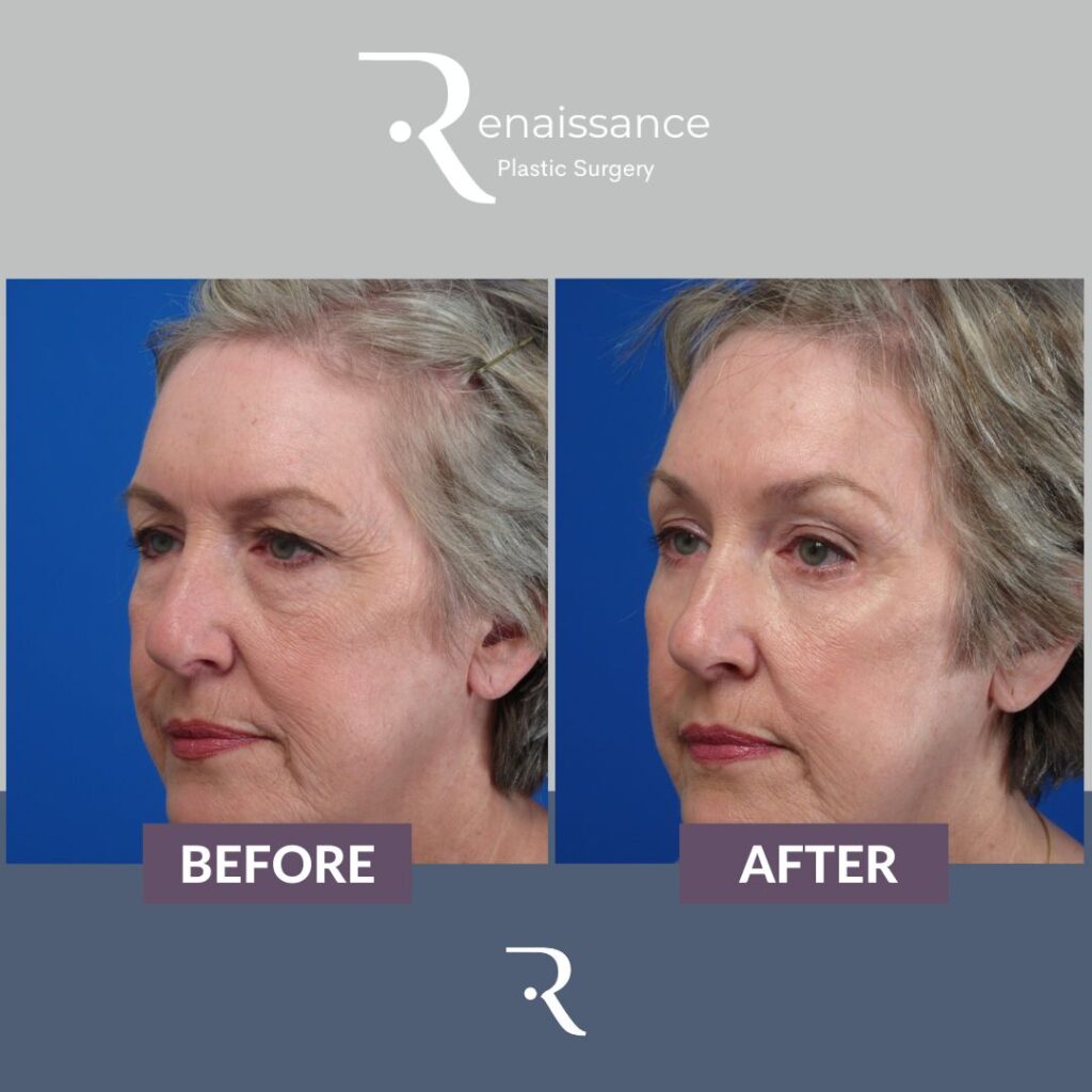 Brow Lift Before and After - Renaissance Plastic Surgery