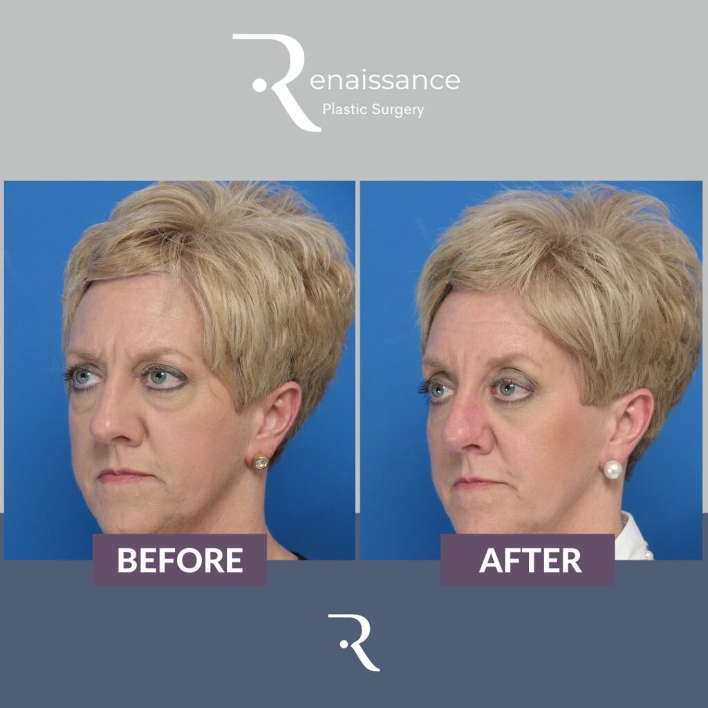 Brow Lift Before and After - Renaissance Plastic Surgery