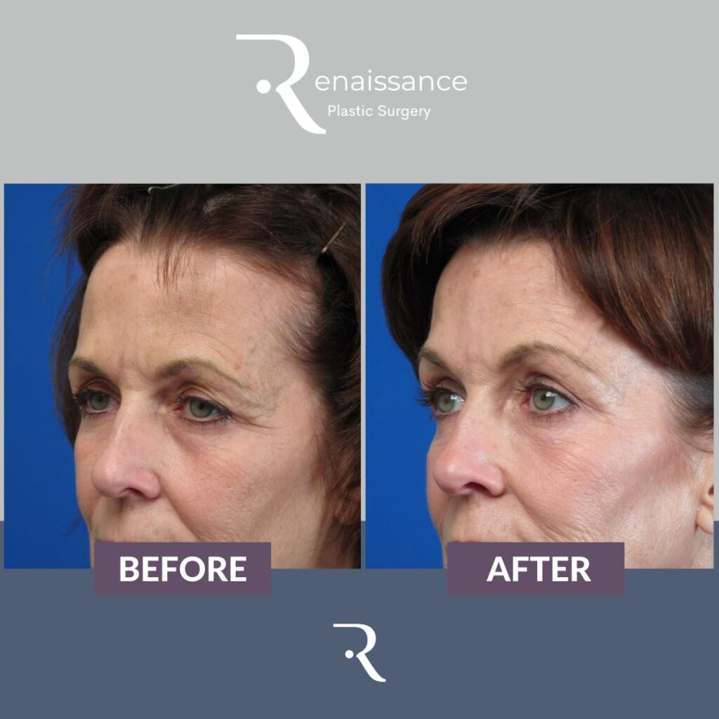Brow Lift Before and After - Renaissance Plastic Surgery