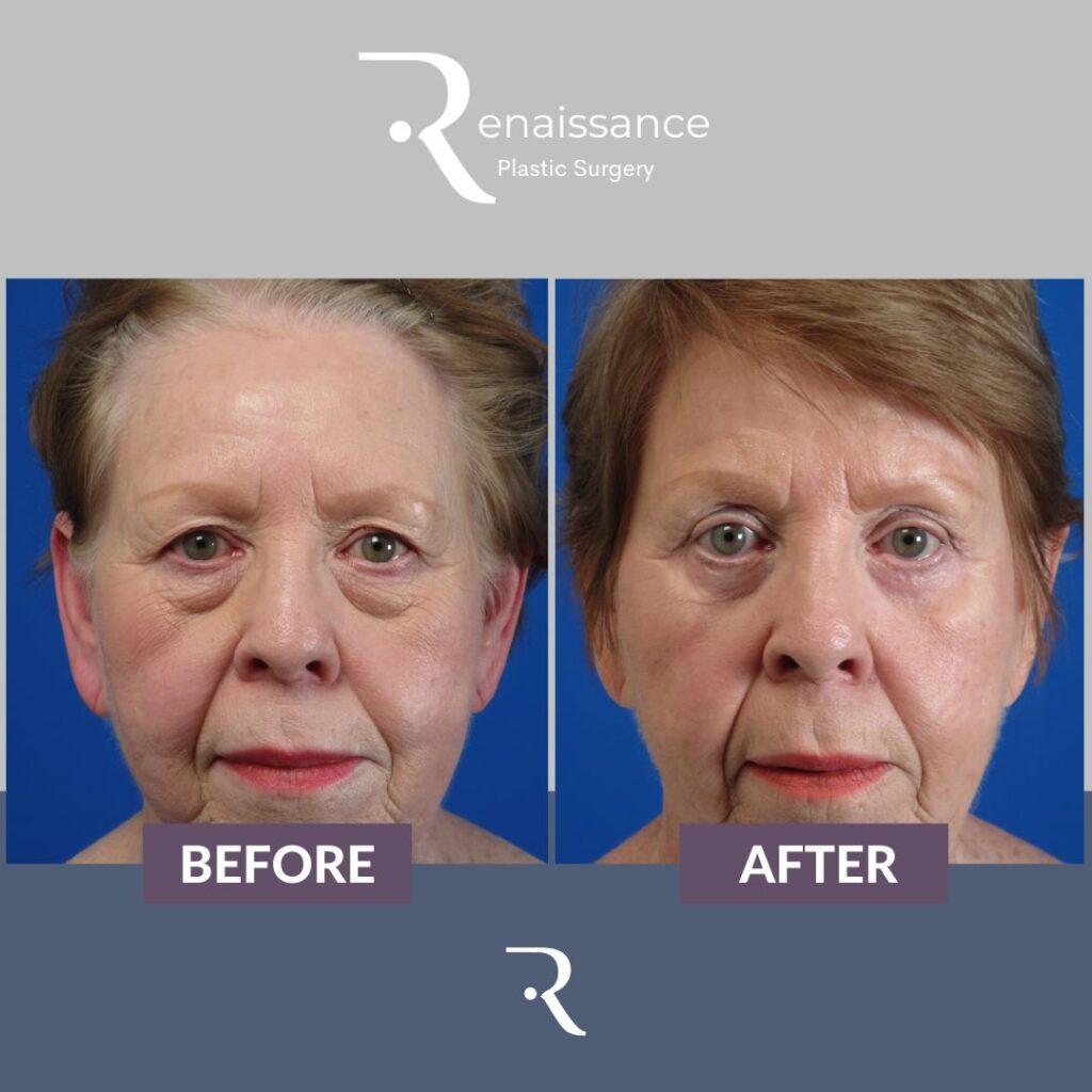 Brow Lift Before and After - Renaissance Plastic Surgery
