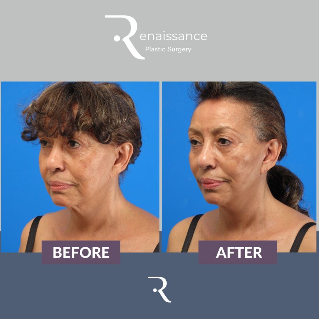 Facelift Before and After - Renaissance Plastic Surgery