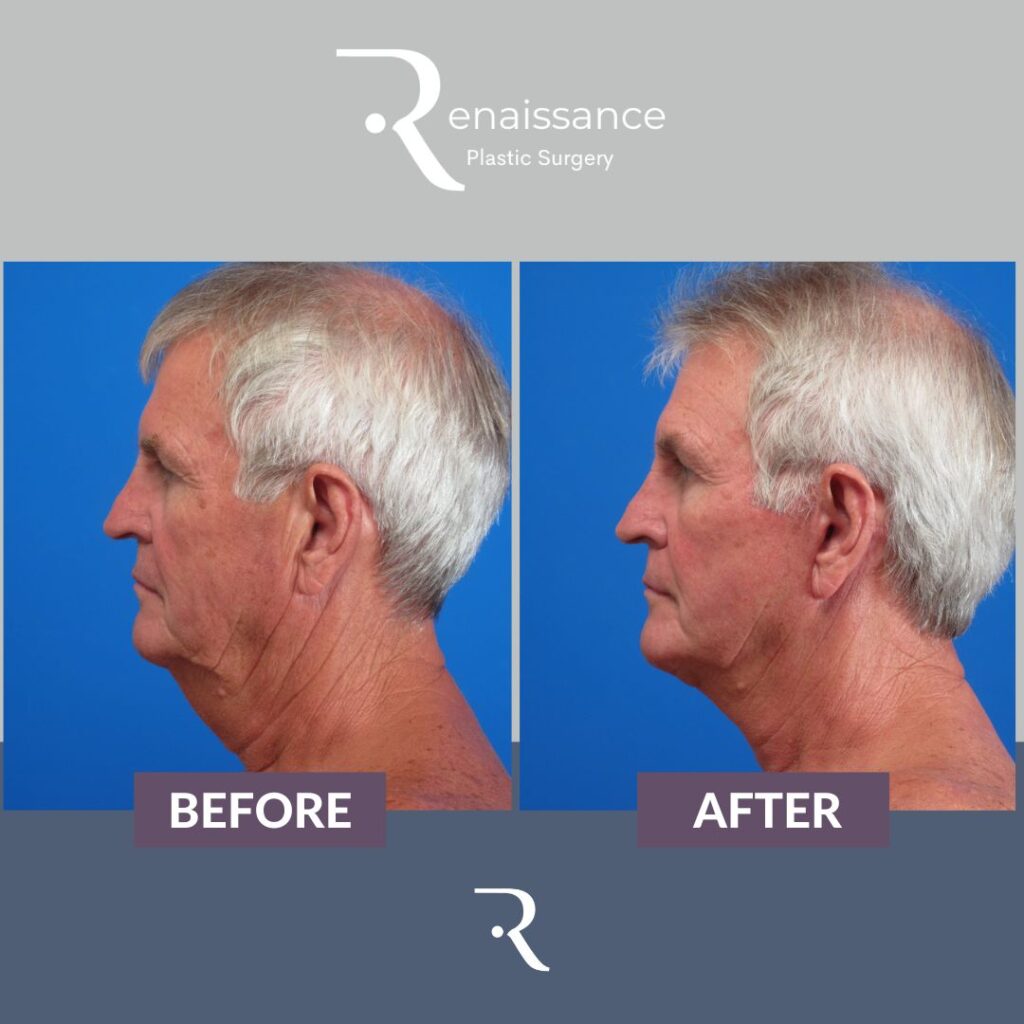Facelift Before and After - Renaissance Plastic Surgery