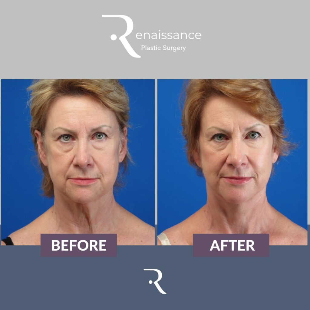 Facelift Before and After - Renaissance Plastic Surgery
