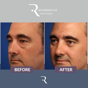 Male Surgery - Renaissance Plastic Surgery