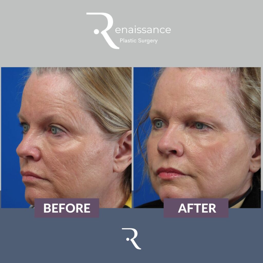 Phenol Peel Before and After - Renaissance Plastic Surgery