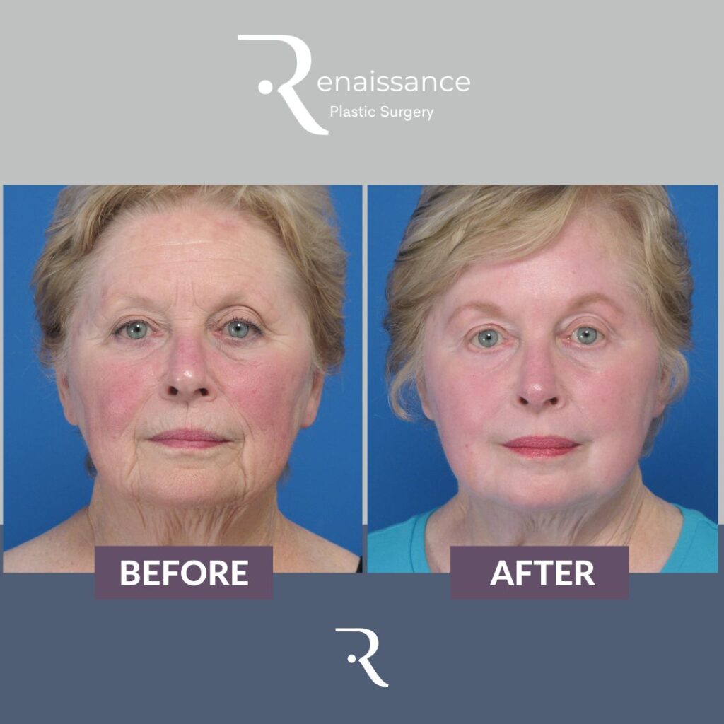 Phenol Peel Before and After - Renaissance Plastic Surgery