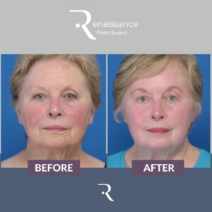 Phenol Peel Before and After - Renaissance Plastic Surgery