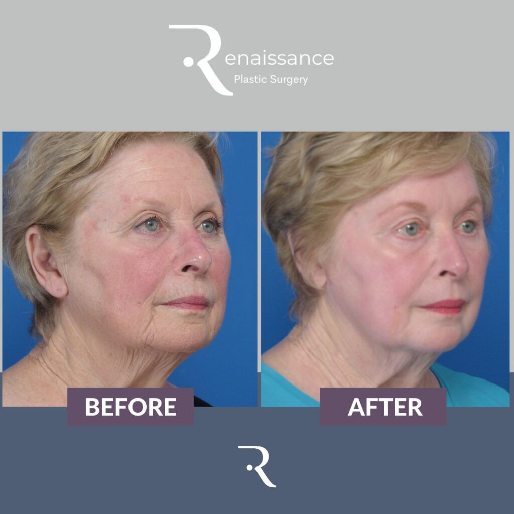 Phenol Peel Before and After - Renaissance Plastic Surgery