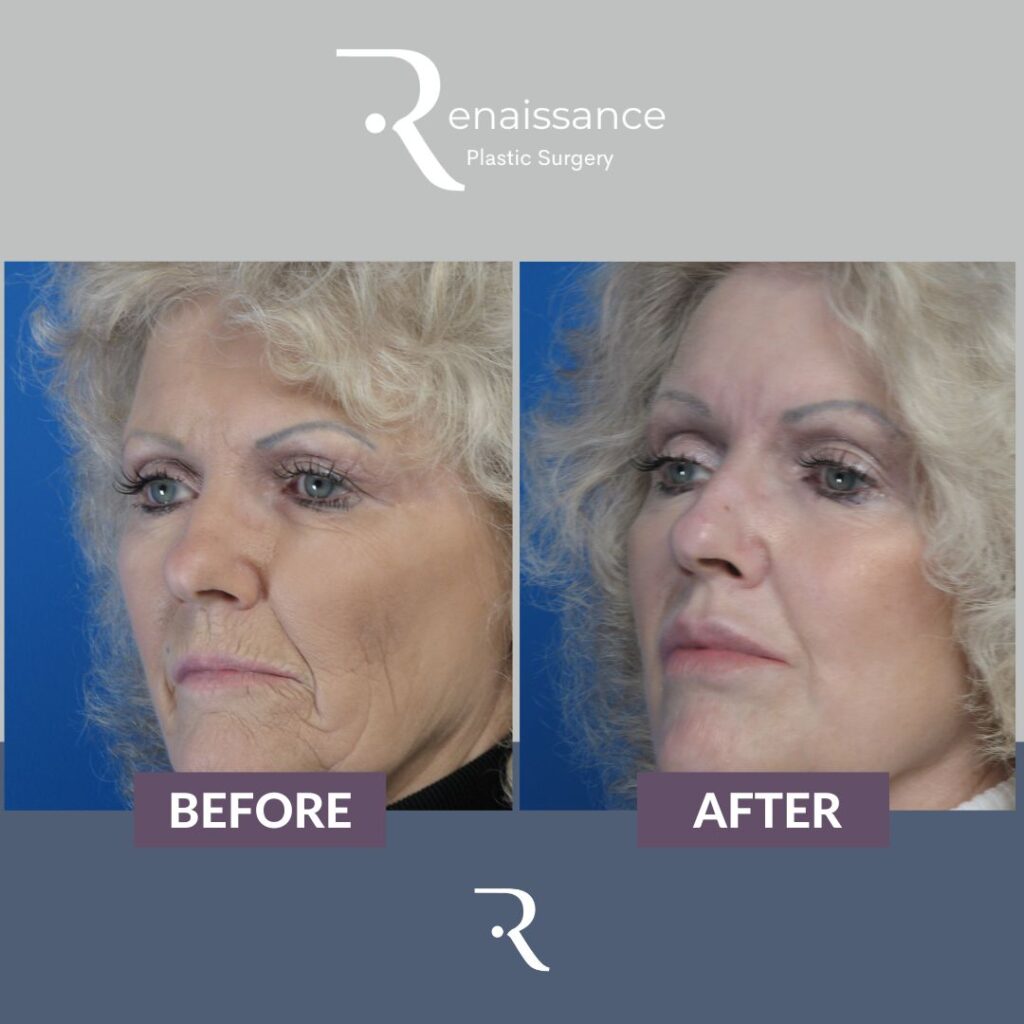 Phenol Peel Before and After - Renaissance Plastic Surgery