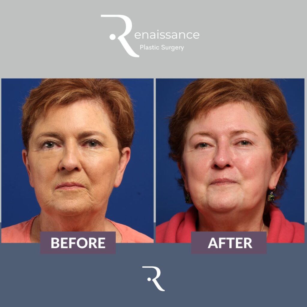 Phenol Peel Before and After - Renaissance Plastic Surgery