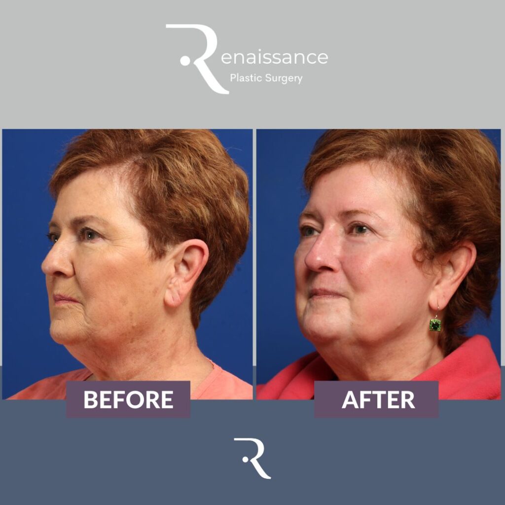 Phenol Peel Before and After - Renaissance Plastic Surgery
