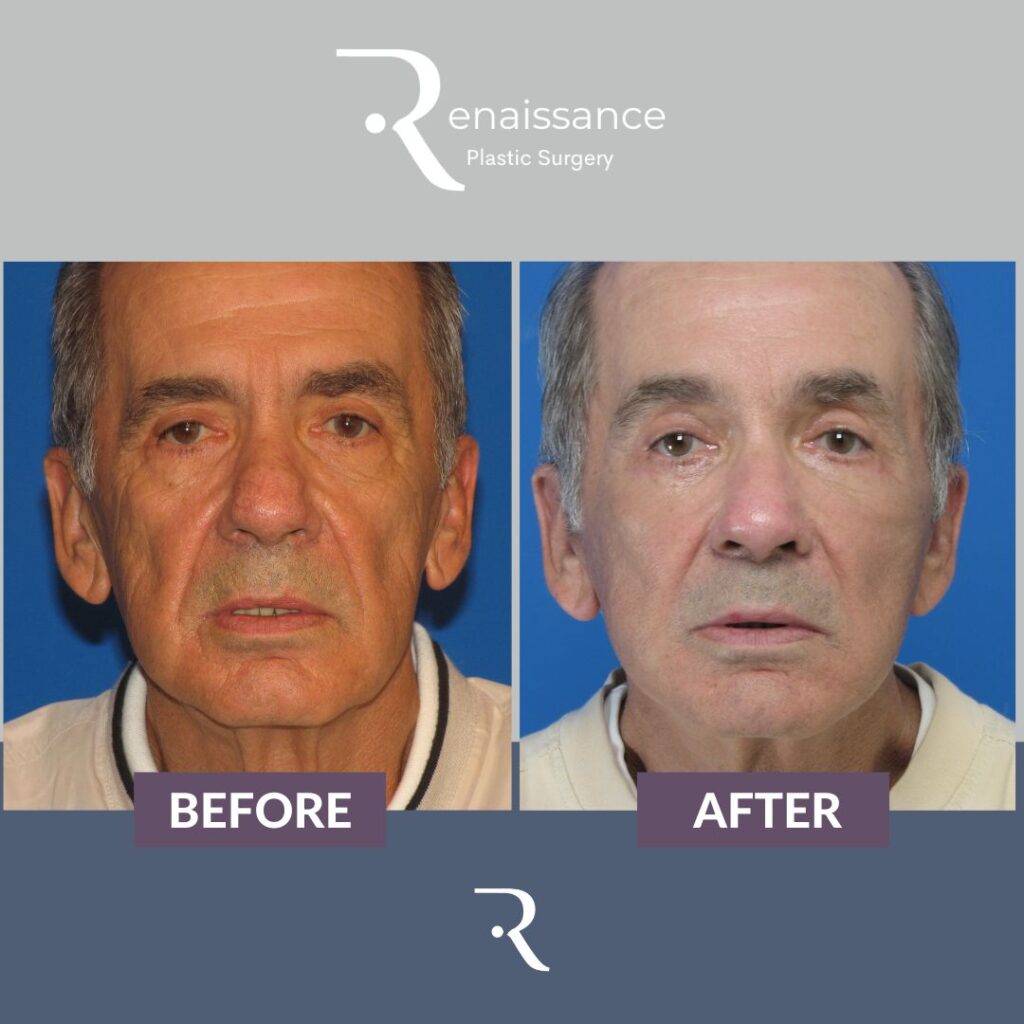 Male Facelift Before and After - Renaissance Plastic Surgery