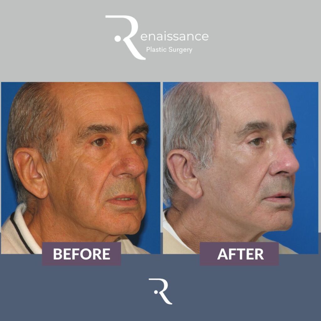 Fat Injection Tear Trough Before and After - Renaissance Plastic Surgery