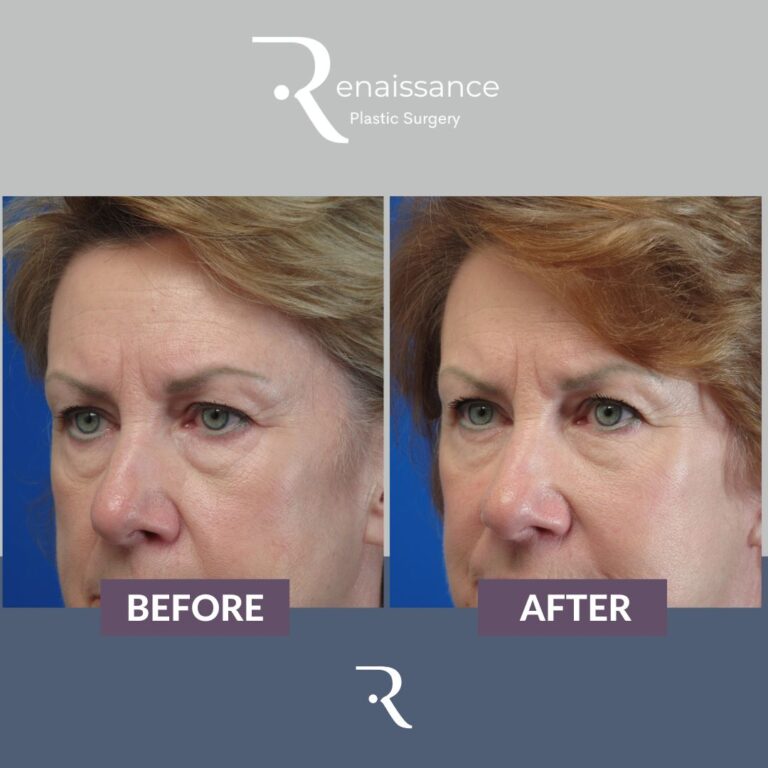 Fat Injection Tear Trough Before and After - Renaissance Plastic Surgery