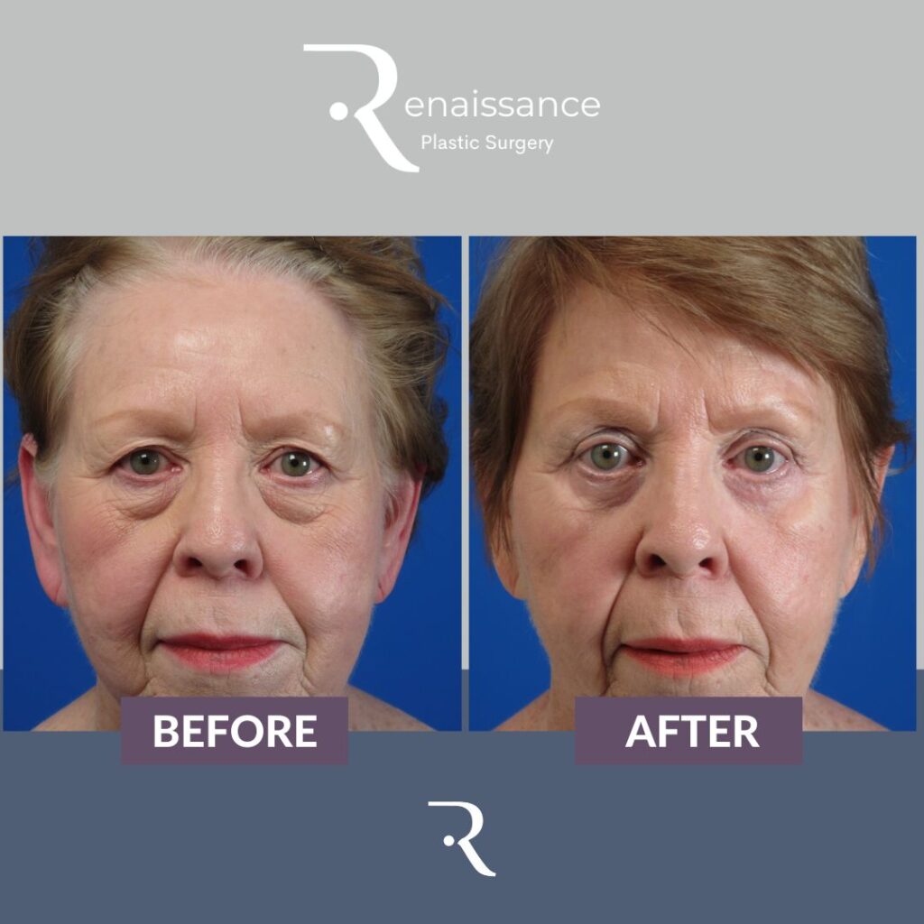 Fat Injection Tear Trough Before and After - Renaissance Plastic Surgery