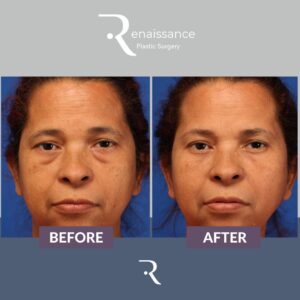 Fat Injection Tear Trough Before and After - Renaissance Plastic Surgery