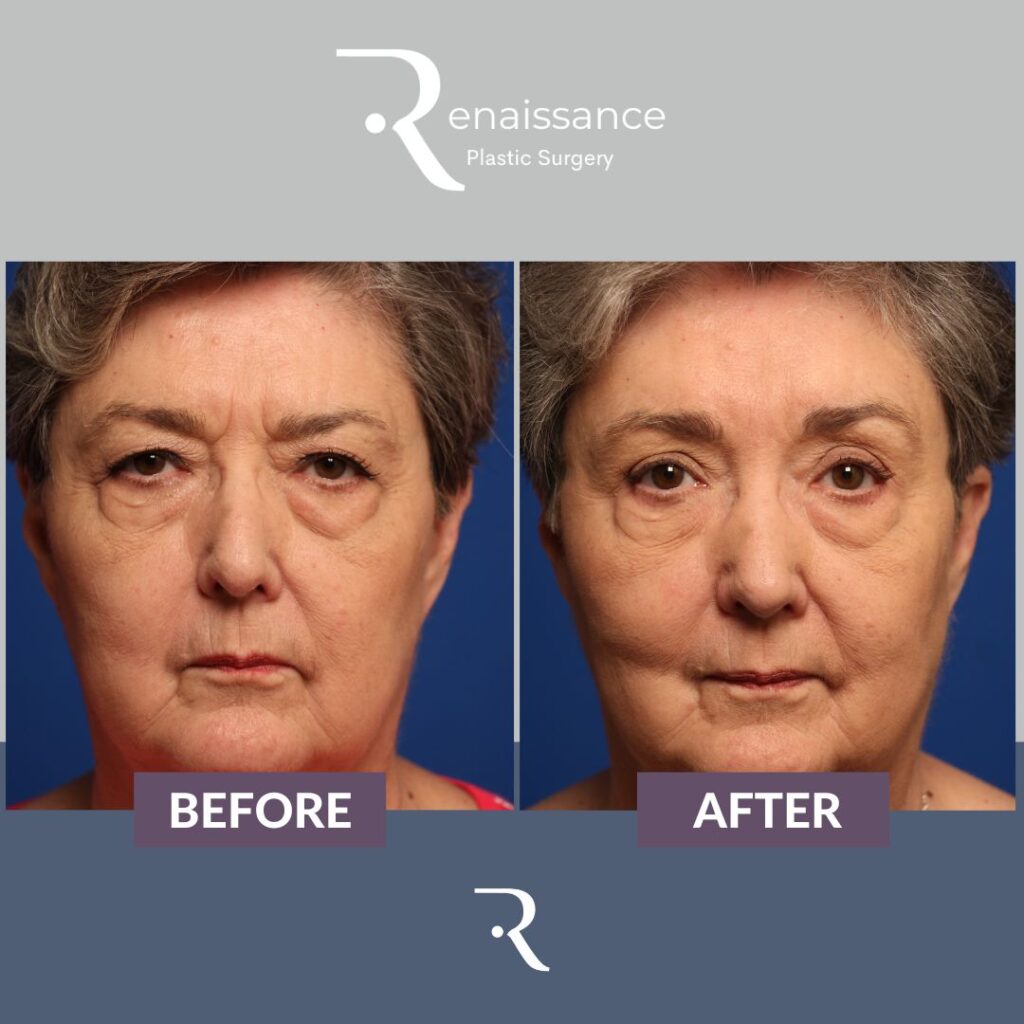 Upper Lower Eyelid Surgery Before and After - Renaissance Plastic Surgery