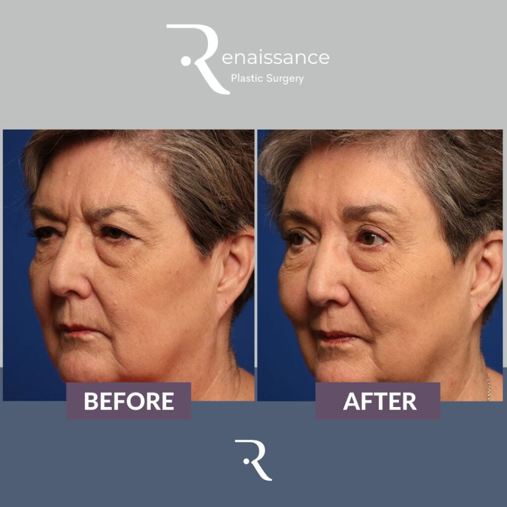 Renaissance Plastic Surgery Macon Ga